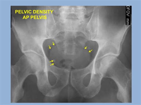 Radiographic Anatomy Of Abd And Pelvis R A Pptx