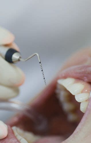 🦷 Tratamiento De Periodontitis Clínica Dental Nobel Clínica Dental