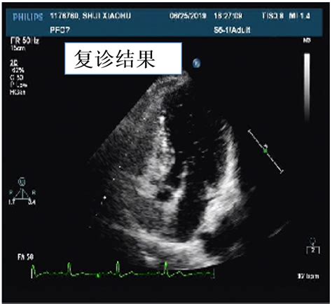 心能学院 病例典集 彭弯隐形杀手 vWD 严道脑血管网