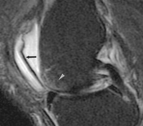 Synovial Plicae In The Knee Ajr
