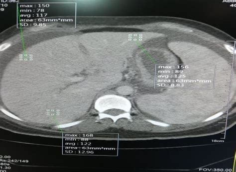 Computer Tomography Image Quality Assessment Of Patient Liver Depicting