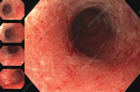 Colon In Ulcerative Colitis Endoscope Views Stock Image C060 9304 Science Photo Library
