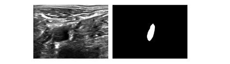 Github Jwliao Ultrasound Nerve Segmentation Kaggle Competition