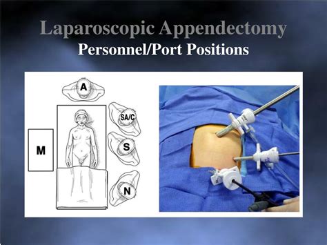 Ppt Appendicitis Current Management Powerpoint Presentation Free Download Id 437141