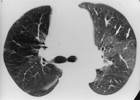 Expiratory High Resolution Ct Diagnostic Value In Diffuse Lung Diseases