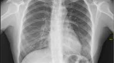 X Ray Discovery Day News Latest X Ray Discovery Day News Breaking X