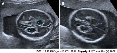 Isolated Choroid Plexus Cysts 25 Year Old Second Pregnancy 20 Wk Of Download Scientific
