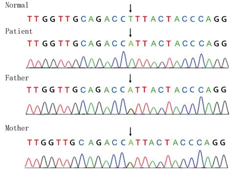 full exon detection and sanger sequencing verification were performed