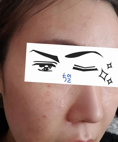 피부과 클라리티 레이저 홍조 혈관 모드 피코 Mla 프락셀 모공 피부 결 효과 통증 주기 가격 한 달 동안 경과 후기 네이버 블로그