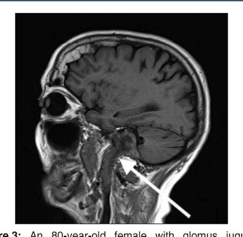 Figure 3 From Glomus Jugulare Tumor Presenting As Deep Vein Thrombosis
