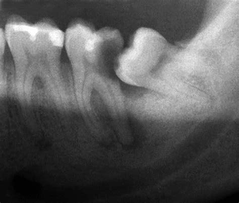 Swollen Gums Causes Treatment And Prevention