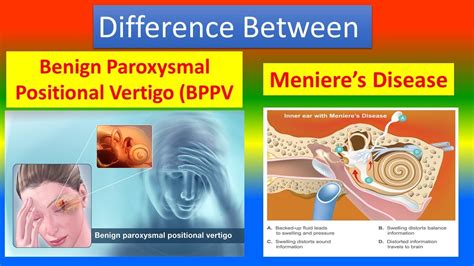Difference Between Benign Paroxysmal Positional Vertigo Bppv And
