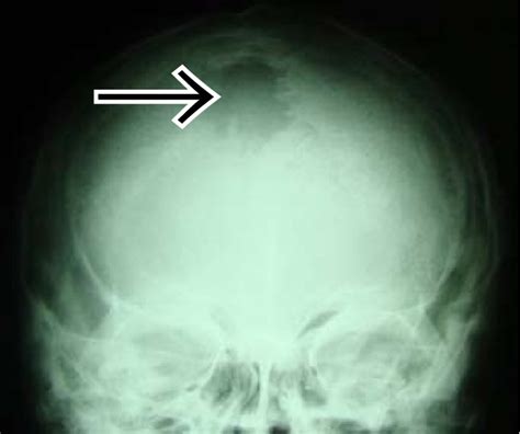 C Another Patient With A Large Parietal Defect Download Scientific Diagram