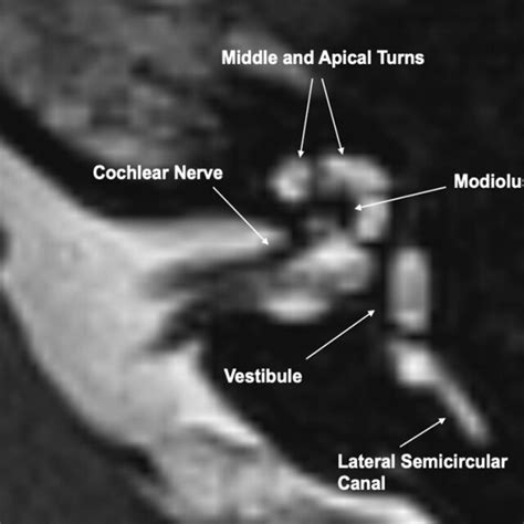 Axial And Coronal Projections Of The Normal Cochlea On Hrct
