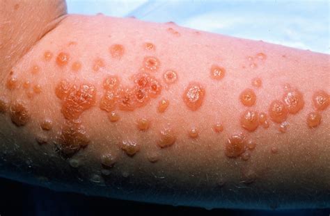 Stevens Johnson Syndrome And Toxic Epidermal Necrolysis Flashcards My