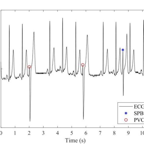 Example Of Single Lead Ecg Signal And Annotations Download Scientific Diagram