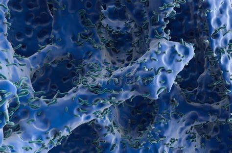 Bone Cancer Osteosarcoma Isometric View 3d Illustration Stock Illustration Illustration Of