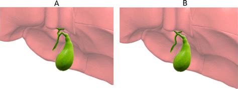 Gallbladder Anatomy Hartmann Pouch
