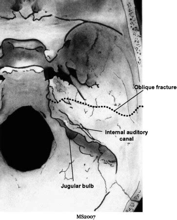 Temporal Bone Fracture Evaluation And Management In The Modern Era Ento Key