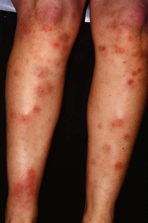 Sarcoidosis Causes Stage Signs Symptoms Diagnosis And Treatment