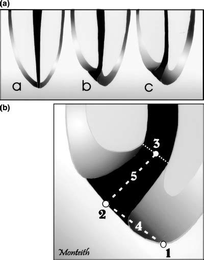 Apical Foramen