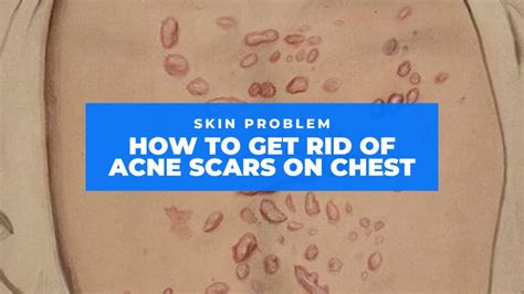 9 Easy Ways How To Get Rid Of Acne Scars On Chest Natural And Medical