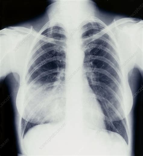 Figure From Detection Of Pneumonia Clouds In Chest X Ray Using Image My Xxx Hot Girl