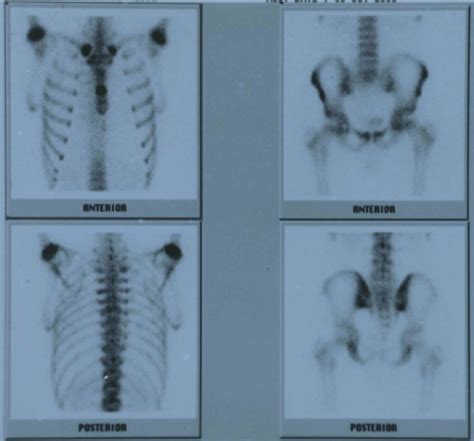Increased Tc 99m Uptake In Bone Scintigraphy And Bulls Head Sign In