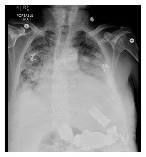 Cxr Showing Severe Cardiomegaly With Diffuse Interstitial And Airspace Download Scientific