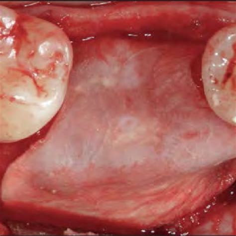 A Periapical Radiograph Showing Angular Bone Defects In 34 B