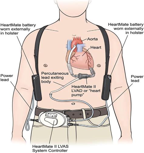 Best Hospital For Lvad Surgery At Louise Collier Blog