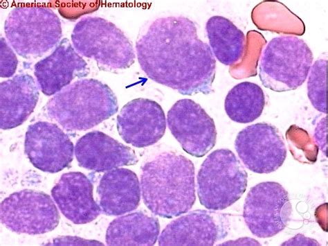 Acute Biphenotypic Leukemia 4