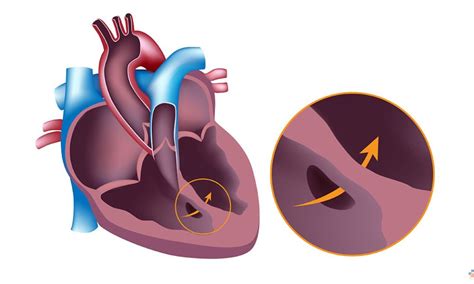 Understanding Ventricular Septal Defect Hole In Heart In Infants