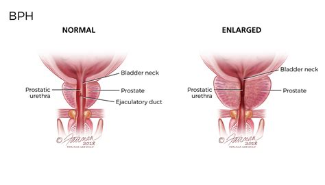 Benign Prostatic Hyperplasia And Prostate Cancer Cancerwalls