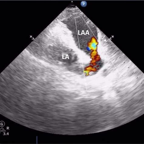 Atrial Flutter Is Seen With A Tachycardia Cycle Length Of 175 Ms Download Scientific Diagram