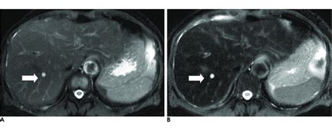Benign Type 4 Hepatic Cyst In A 65 Year Old Woman Precontrast Download Scientific Diagram