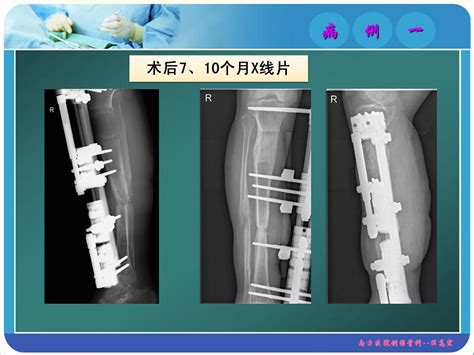 游离皮瓣移植失败后的大面积软组织缺损修复探讨 医学文章 唯医 allinmd
