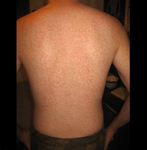 What Does HIV Rash Looks Like STD Testing Near Me