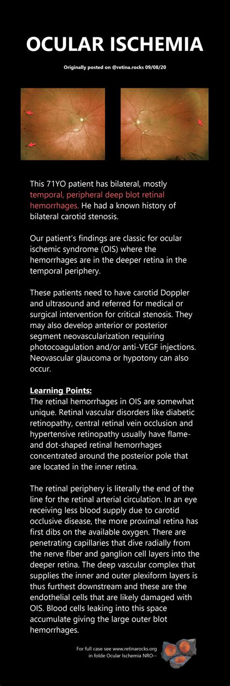 Retinal Vascular Disorders Misc Ocular Ischemia Retina Rocks