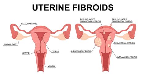 Which Size Of Fibroids Is Dangerous Afc
