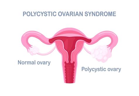 Yoga For Pcos And Pcod 7 Yoga Poses For Pcod