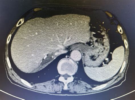 Laparoscopic Anatomical Liver Segment Vii Resection With Liver Parenchymal Transection Following