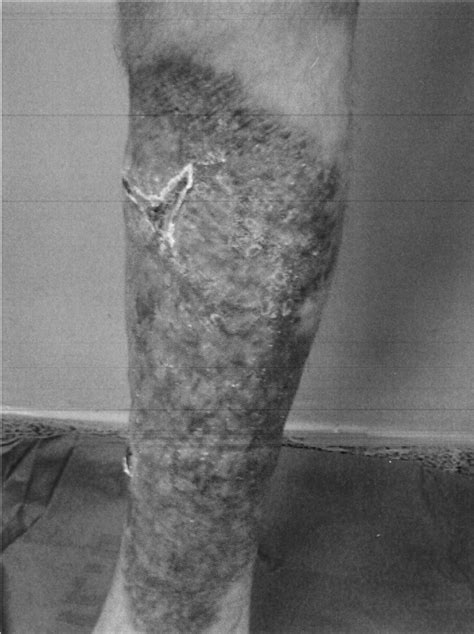 A Huge Pyoderma Gangrenosum Like Lesion As A Presenting Sign Of