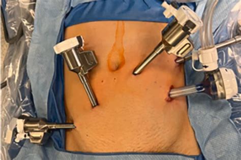 Robotic Rplnd Drsachinnataraj