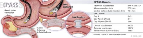 Long Term Outcomes Of Eus Guided Balloon Occluded Gastrojejunostomy