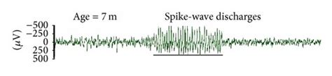 Examples Of Epileptic Activity Spike Wave Discharges Swd And Sleep Download Scientific