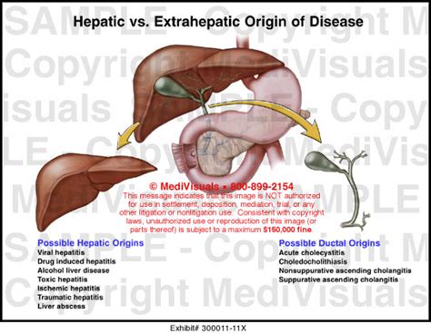 Hepatic Vs Extrahepatic Origin Of Disease Medical Illustration