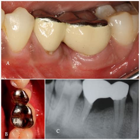 Root Resection For Future Implant Site Development The Transitional Approach Medcrave Online