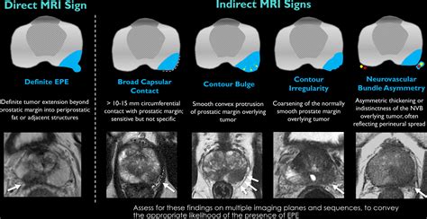 Local Staging Of Prostate Cancer At Mri What The Urologist And Radiation Oncologist Want To