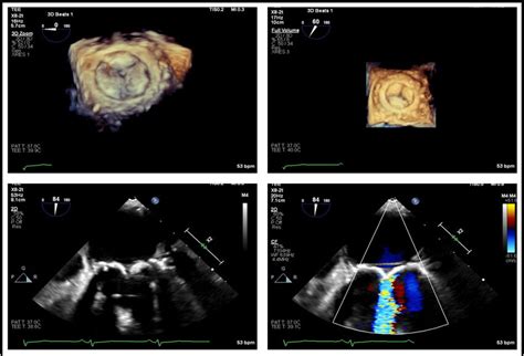 Transesophageal Echocardiogram Re Demonstrating Severe Mitral Stenosis